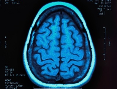 Imaging of Veterans’ Brains Suggests Sub-types of Gulf War Illness