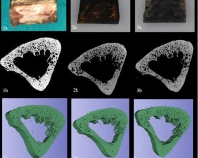 Researchers Use Radiomics in Forensic Examination of Charred Human Bones