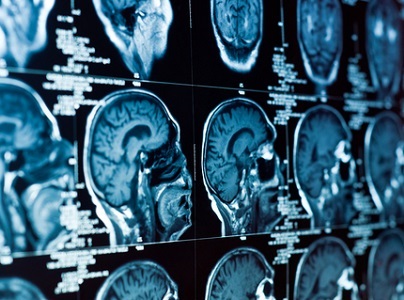 Can Postmortem CT Scans Replace Autopsies?