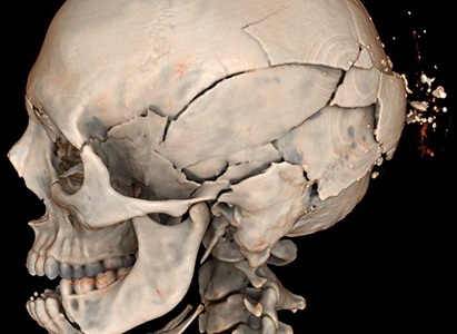 Q&A: CT Scans Shed New Light in Forensic Probes